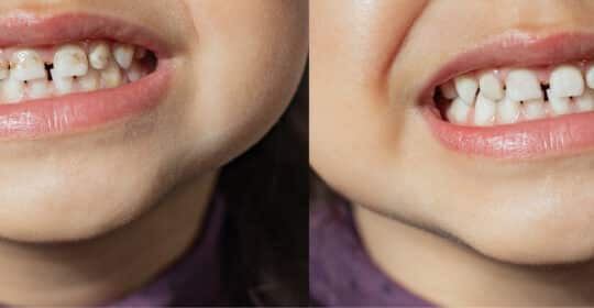 My Child’s Teeth Look Stained | Angela Evanson, DDS